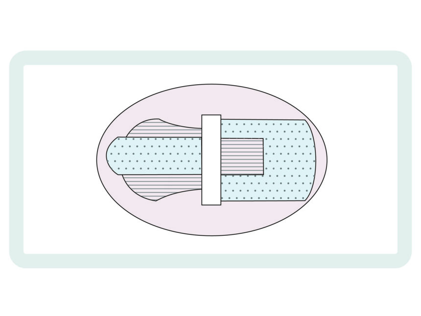 UriCap Female Device – Starter, Base & Change Kits | TillaCare